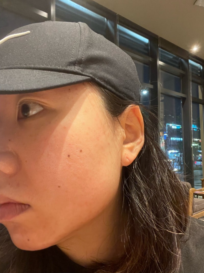 광고x 피부과 X 모낭염 자가 치료관리법 모낭염 증상 및 원인 항생제 연고 여드름약 부작용 네이버 블로그