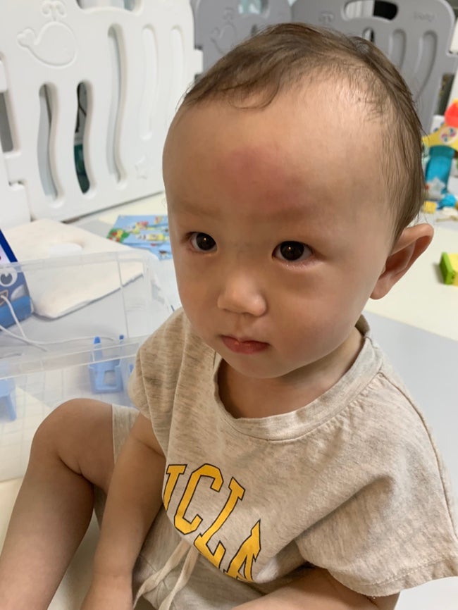 아기 낙상사고 17개월아기 낙상으로 응급실 다녀왔어요 아기 뇌진탕 낙상 후 증상 응급실 처치 예후 아기