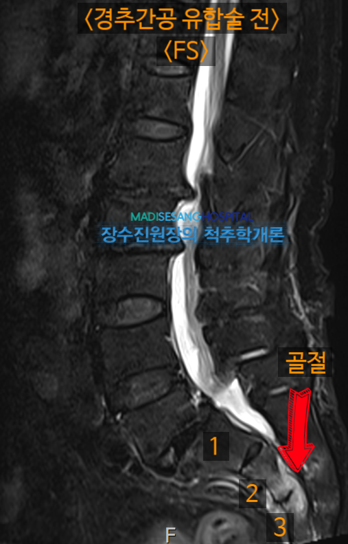치료의 선택과 집중 경추간공 유합술 Tlif 네이버 블로그
