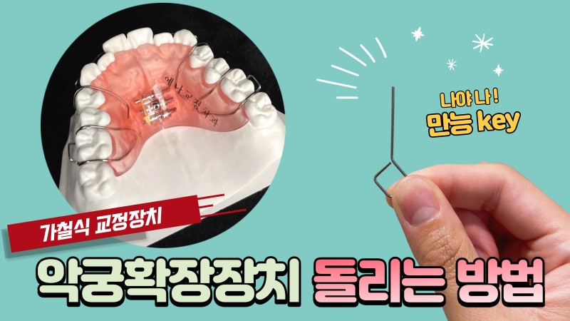 가철식 고정식 악궁확장장치 돌리는 방법 소아어린이 가철성장치 회전방법 횟수 세척 관리방법 동영상 네이버 블로그