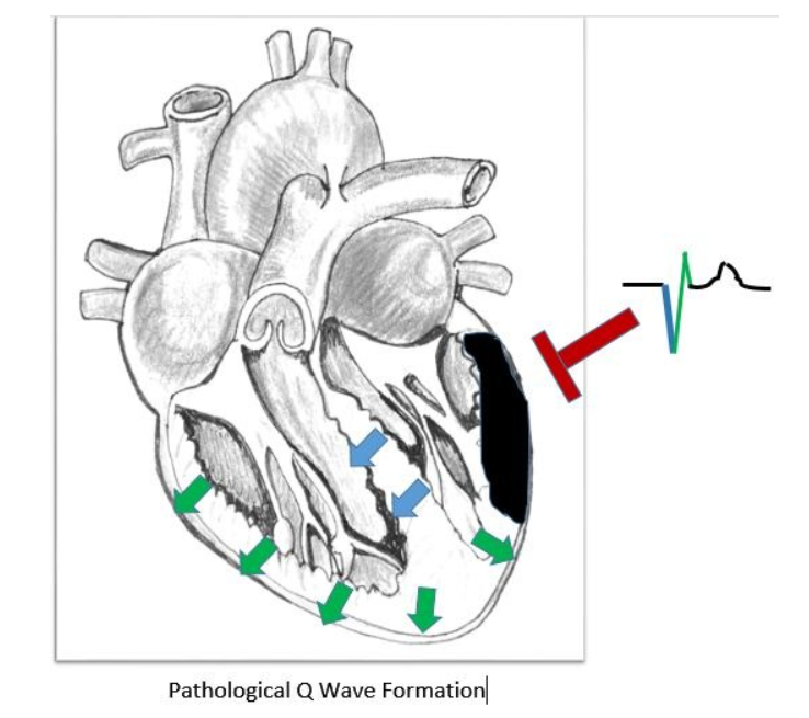 [ECG공부] 심전도 P파(심방이상), Q파, pathologic Q파. : 네이버 블로그