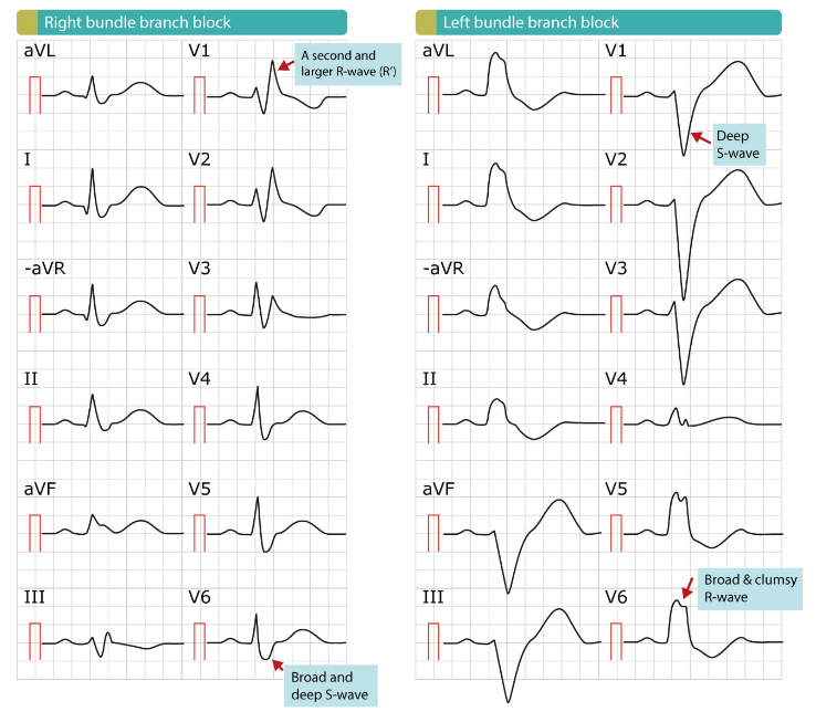 [ECG공부] 우각차단RBBB, 좌각차단LBBB : 네이버 블로그