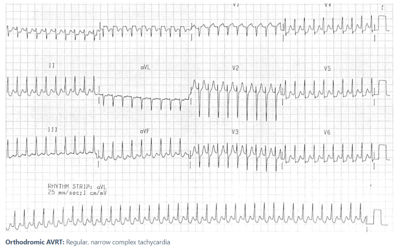 PSVT(발작성 심실상성 빈맥, Paroxysmal supraventricular tachycardia) AVNRT vs ...