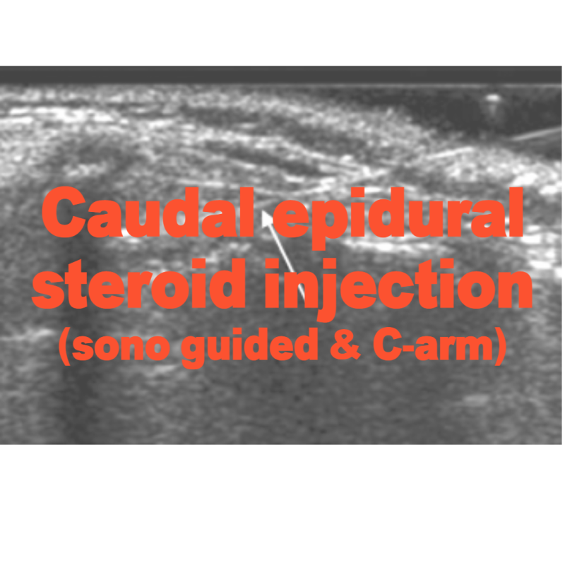 [의사용] Caudal epidural steroid injection : 네이버 블로그