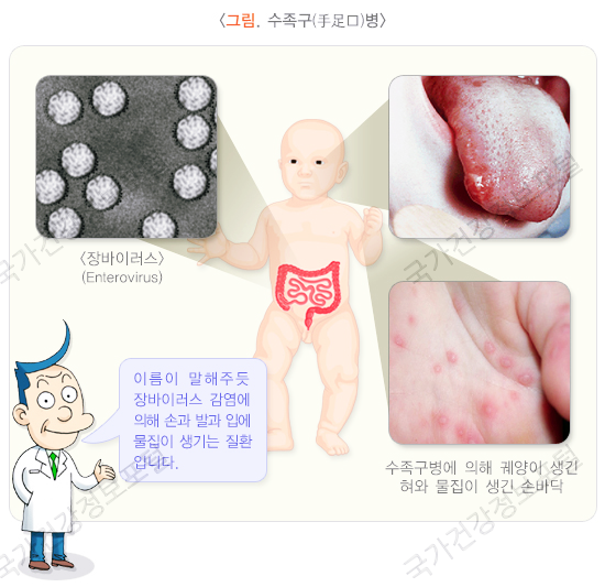 태아보험 불필요특약 수족구진단담보 보장내용 및 비추천 이유 네이버 블로그