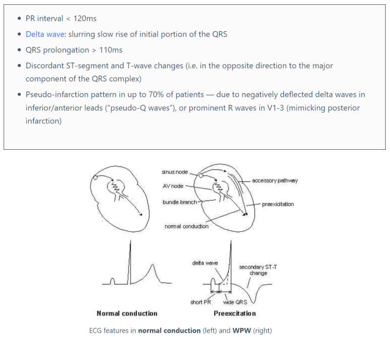 [심전도] WPW syndrome (wolff-parkinson-white), Atrial fibrillation in WPW ...