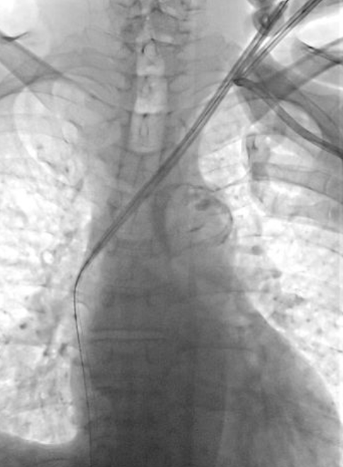터널식 투석용카테터(Perm Catheter)-중심정맥관 : 네이버 블로그