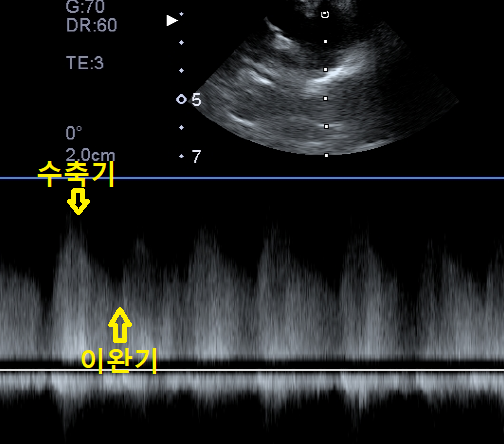 강아지 선천성 심장병 / 동맥관개존증 / PDA / L to R shunt / R to L shunt / 폐성고혈압 / PH ...