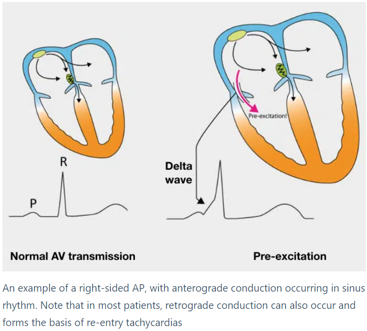 [심전도] WPW syndrome (wolff-parkinson-white), Atrial fibrillation in WPW ...