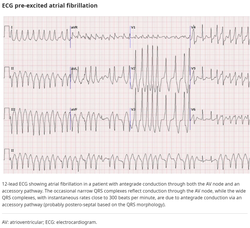 [심전도] WPW syndrome (wolff-parkinson-white), Atrial fibrillation in WPW ...