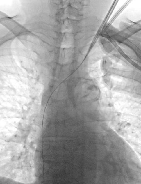 터널식 투석용카테터(Perm Catheter)-중심정맥관 : 네이버 블로그