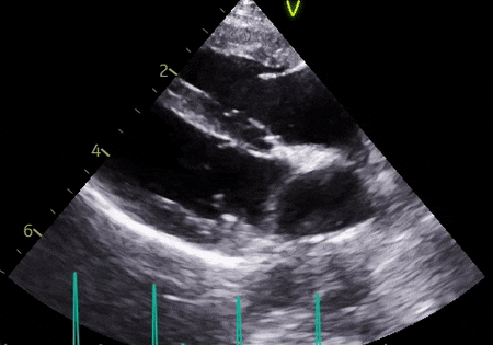 강아지 선천성 심장병 / 동맥관개존증 / PDA / L to R shunt / R to L shunt / 폐성고혈압 / PH ...