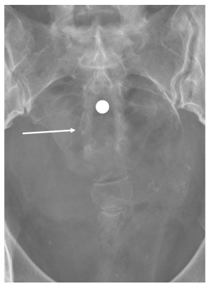 [의사용] Caudal epidural steroid injection : 네이버 블로그