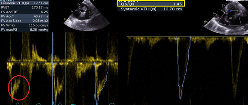 강아지 선천성 심장병 / 동맥관개존증 / PDA / L to R shunt / R to L shunt / 폐성고혈압 / PH ...