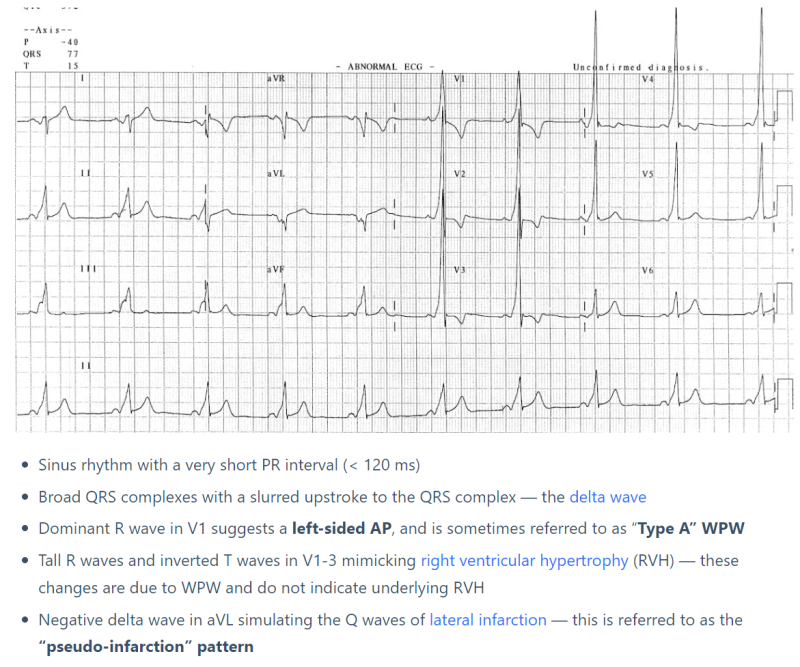 [심전도] WPW syndrome (wolff-parkinson-white), Atrial fibrillation in WPW ...