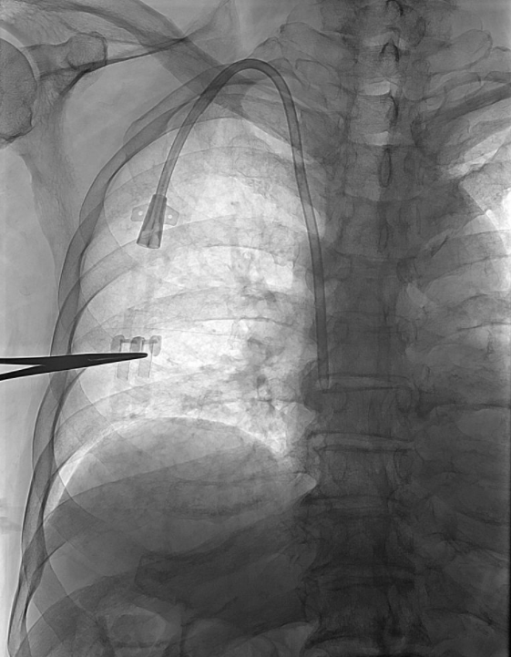 터널식 투석용카테터(Perm Catheter)-중심정맥관 : 네이버 블로그