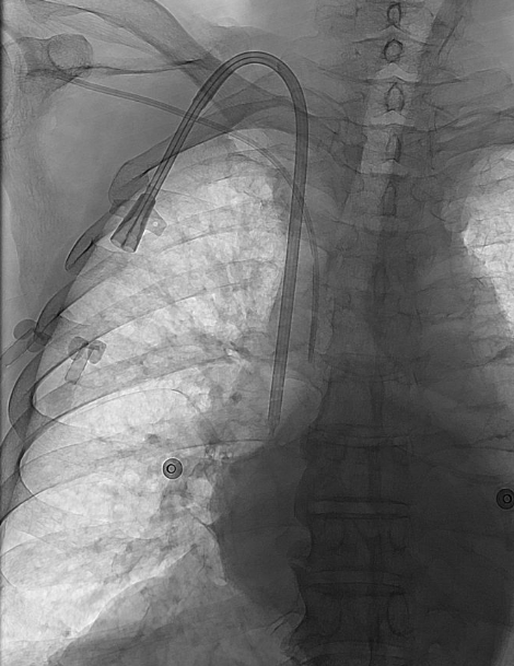 터널식 투석용카테터(Perm Catheter)-중심정맥관 : 네이버 블로그