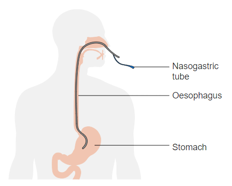 L-tube(levin tube) 비위관 위치확인 및 간호 : 네이버 블로그