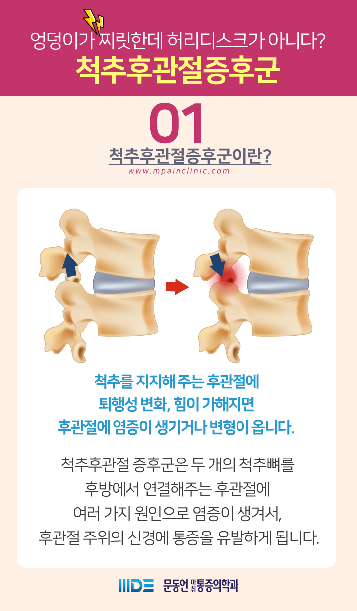 왼쪽오른쪽 허리 돌릴때 통증 척추 후관절 증후군파셋증후군 증상과 치료 네이버 블로그