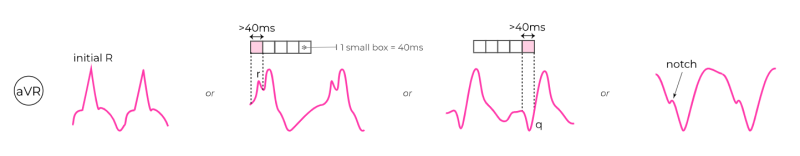 Ventricular tachycardia (심실 빈맥, VT) : 네이버 블로그