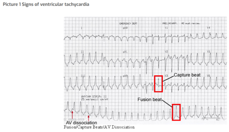 Ventricular tachycardia (심실 빈맥, VT) : 네이버 블로그