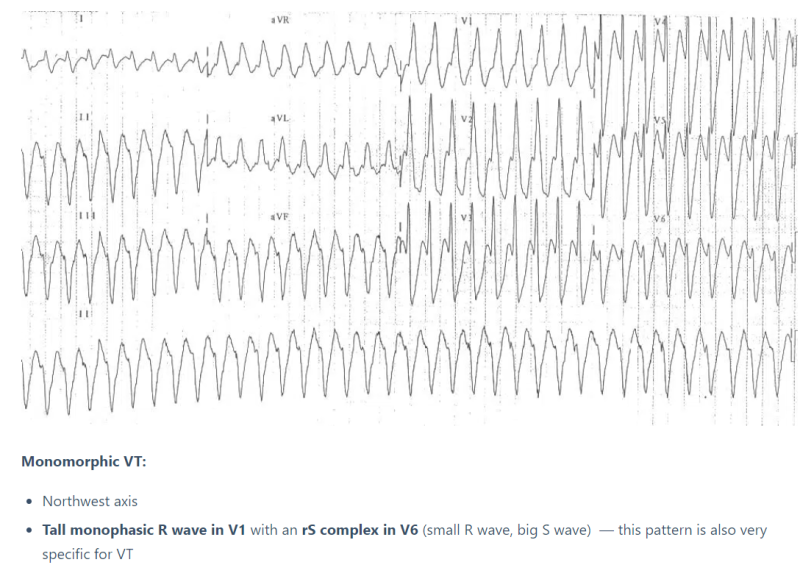 Ventricular tachycardia (심실 빈맥, VT) : 네이버 블로그