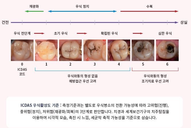 충치, 치아 우식의 측정과 평가, ICDAS : 네이버 블로그