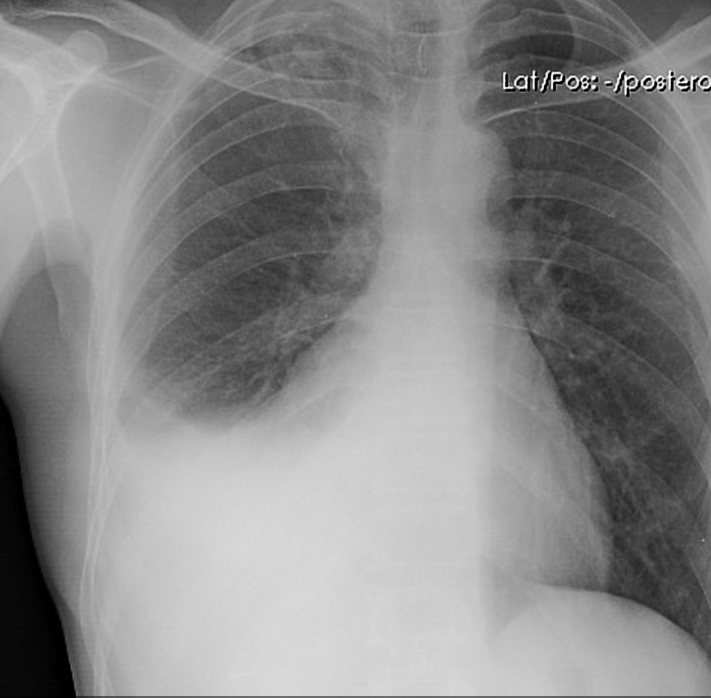 Pleural effusion (흉막 삼출) (exudate vs transudate), Thoracentesis. : 네이버 블로그