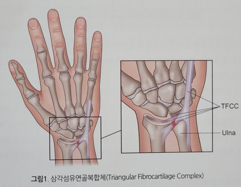 삼각섬유연골복합체 손상 손목 바깥쪽이 시큰거리고 아파서 힘을 줄 수가 없어요 네이버 블로그
