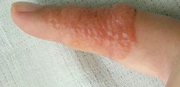 손가락 한포진 발바닥 한포진 원인 발바닥 발가락 피부 손에 물집 발에 물집 생겼을때 새끼발가락 물집 네이버 블로그
