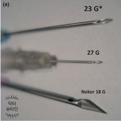 '서브시전(Subcision)'이 뭐야?(파인 흉터,여드름 흉터,위축성 흉터,함몰 흉터,원리,효과,적응증,전후사진,주의사항 ...