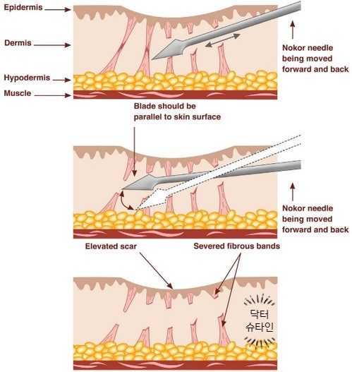 '서브시전(Subcision)'이 뭐야?(파인 흉터,여드름 흉터,위축성 흉터,함몰 흉터,원리,효과,적응증,전후사진,주의사항 ...