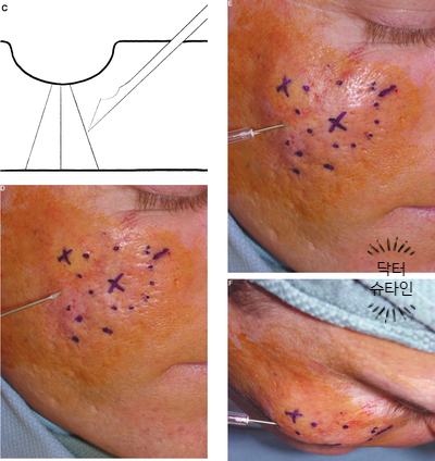 '서브시전(Subcision)'이 뭐야?(파인 흉터,여드름 흉터,위축성 흉터,함몰 흉터,원리,효과,적응증,전후사진,주의사항 ...