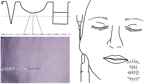 '서브시전(Subcision)'이 뭐야?(파인 흉터,여드름 흉터,위축성 흉터,함몰 흉터,원리,효과,적응증,전후사진,주의사항 ...