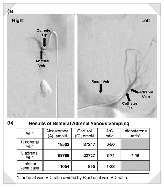 부신정맥채혈술(AVS, adrenal venous sampling) : 네이버 블로그