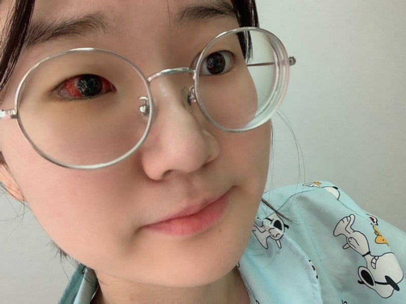 망막박리 공막돌륭술 후기 New 수술 3년 째 25년 4월 9일 외래 네이버 블로그