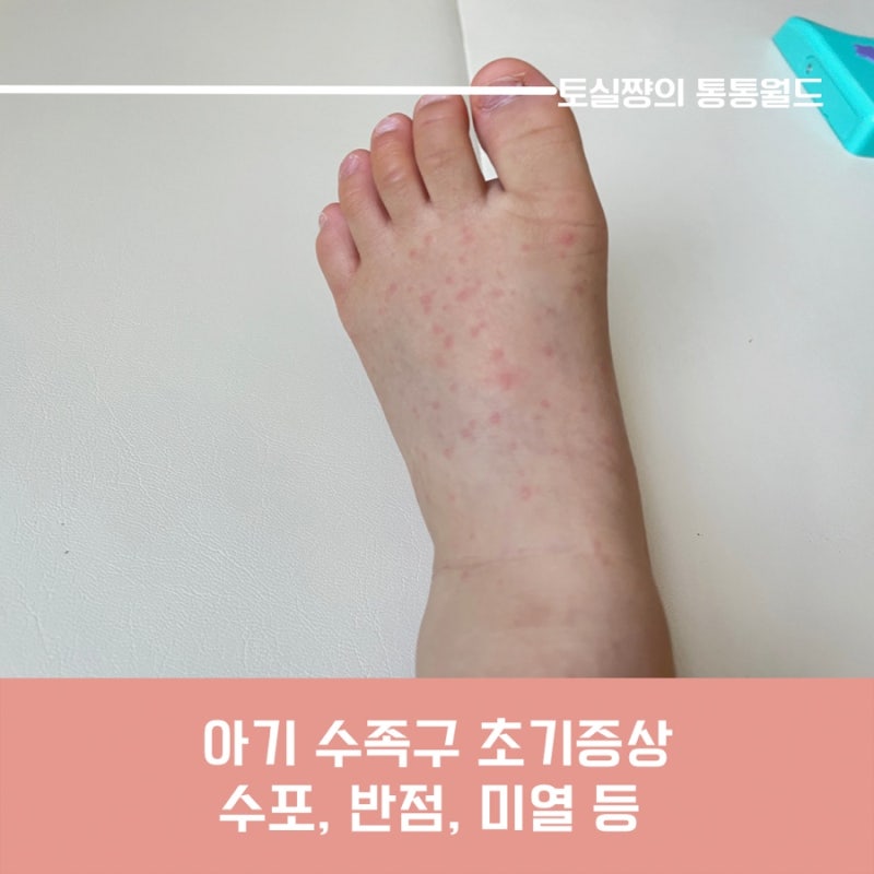 아기 수족구 잠복기 초기증상 수포 기록 수족구미열 심한수족구 비정형수족구 네이버 블로그