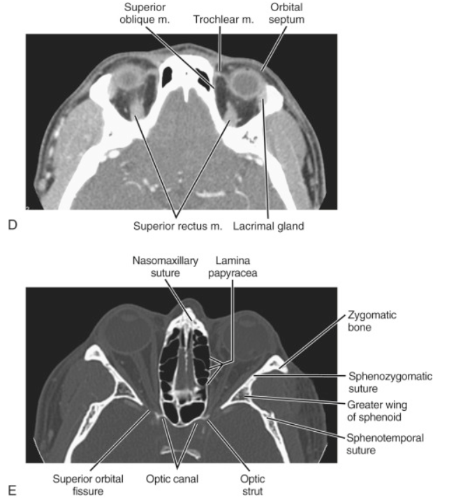Ocular infection(안구 감염)- 안와봉와직염 : 네이버 블로그