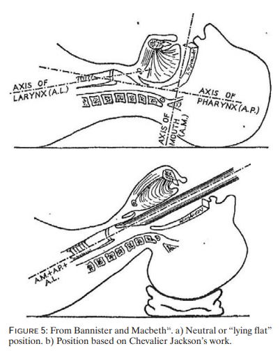기도삽관intubation을 잘하기 위한 최적의 position (ft. sniffing position) : 네이버 블로그