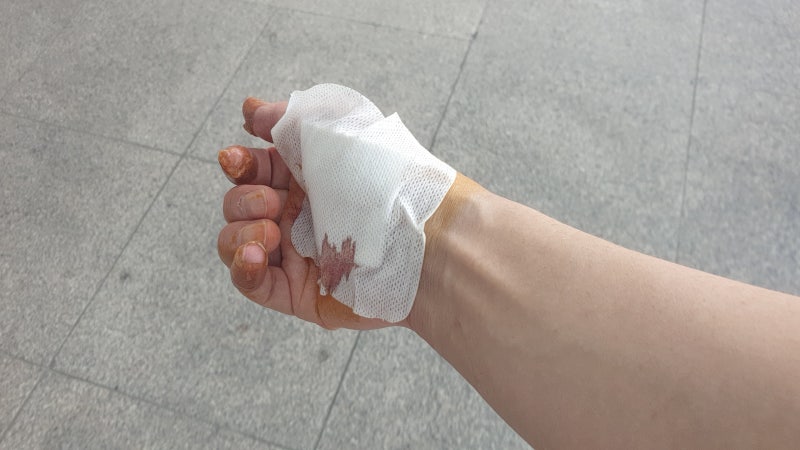 백혈병 투병일기 조혈모세포이식 후 골절사고 손목 주상골 골절 자전거 및 야외활동 금지 급성골수성백혈병 네이버 블로그