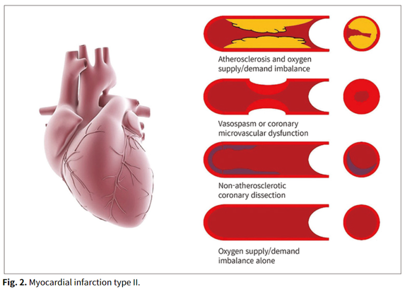 심근경색( Myocardial infarction) Type 1 MI vs Type 2 MI 차이. : 네이버 블로그