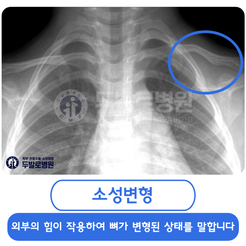 서울소아정형외과 소아 골절의 종류에 대해서 알려드리겠습니다 네이버 블로그