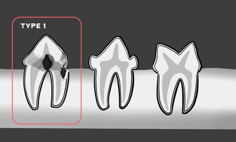 치아흡수성병변 (FORL : Feline Odontoplastic Resorptive Lesion) : 네이버 블로그
