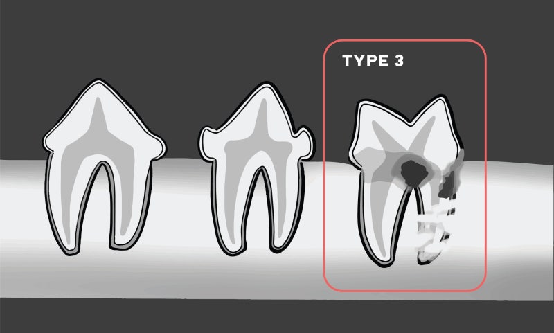 치아흡수성병변 (FORL : Feline Odontoplastic Resorptive Lesion) : 네이버 블로그