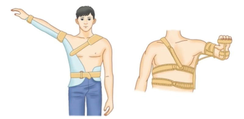 팔신경얼기손상상완신경총손상 유형 9가지 네이버 블로그