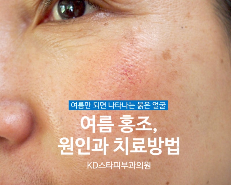 강동구피부과가벼운 여름 안면홍조 원인과 치료방법은 네이버 블로그