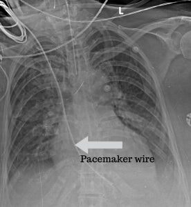 임시형 인공심박동기의 적용 - Percutaneous pacemaker, Transvenous temporary ...