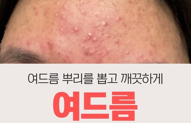 마곡여드름 치료 잘하는 피부과 By Dr Jini 발산역여드름 네이버 블로그