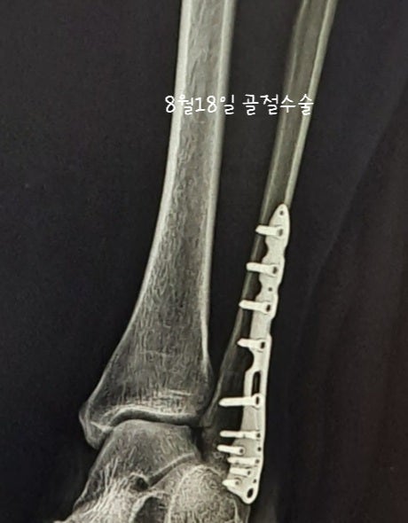 발목 철심 제거수술 전검사수술당일1 네이버 블로그