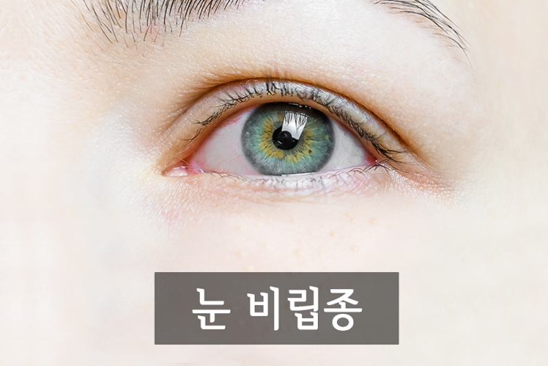 얼굴 눈 비립종 셀프 제거 하는법 네이버 블로그